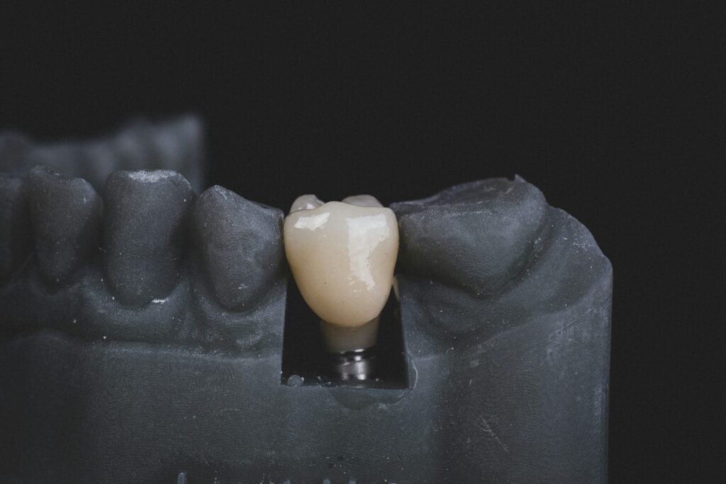 Single Or Full-Arch Implants: Which Is The Right Choice For Me ...