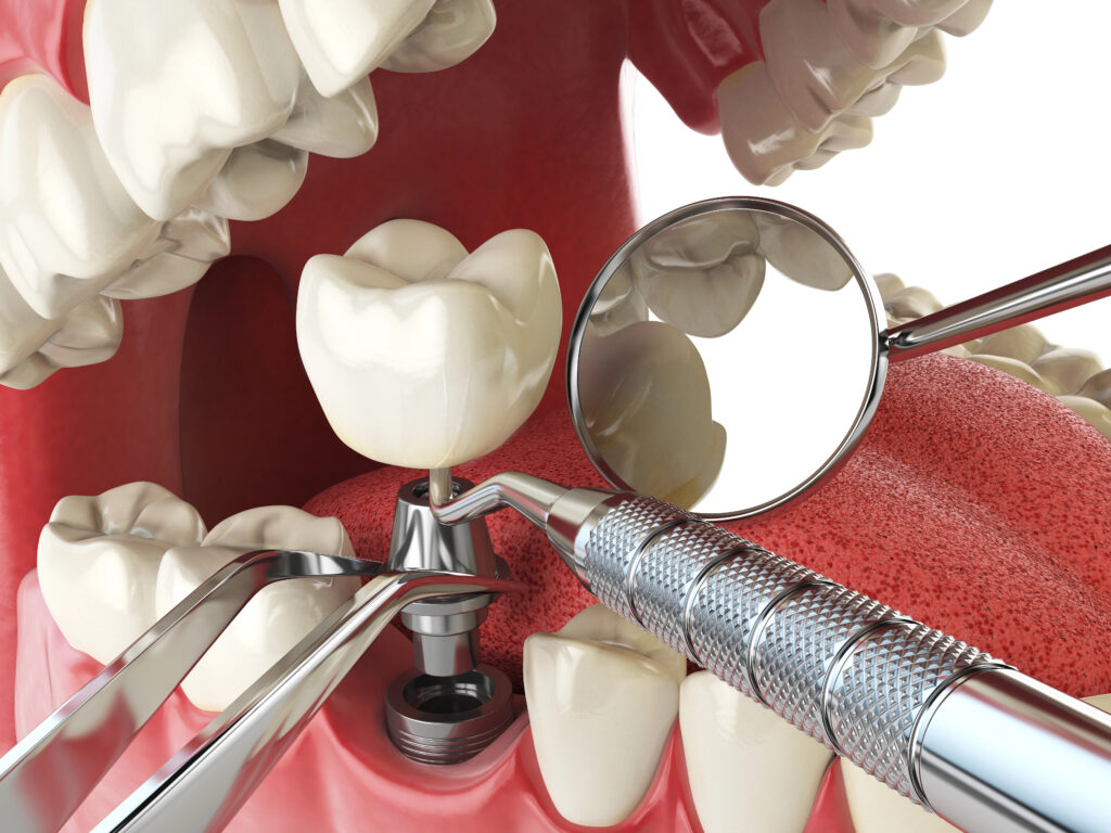 Periodontist Vs. Maxillofacial Surgeon - Doctors Implants