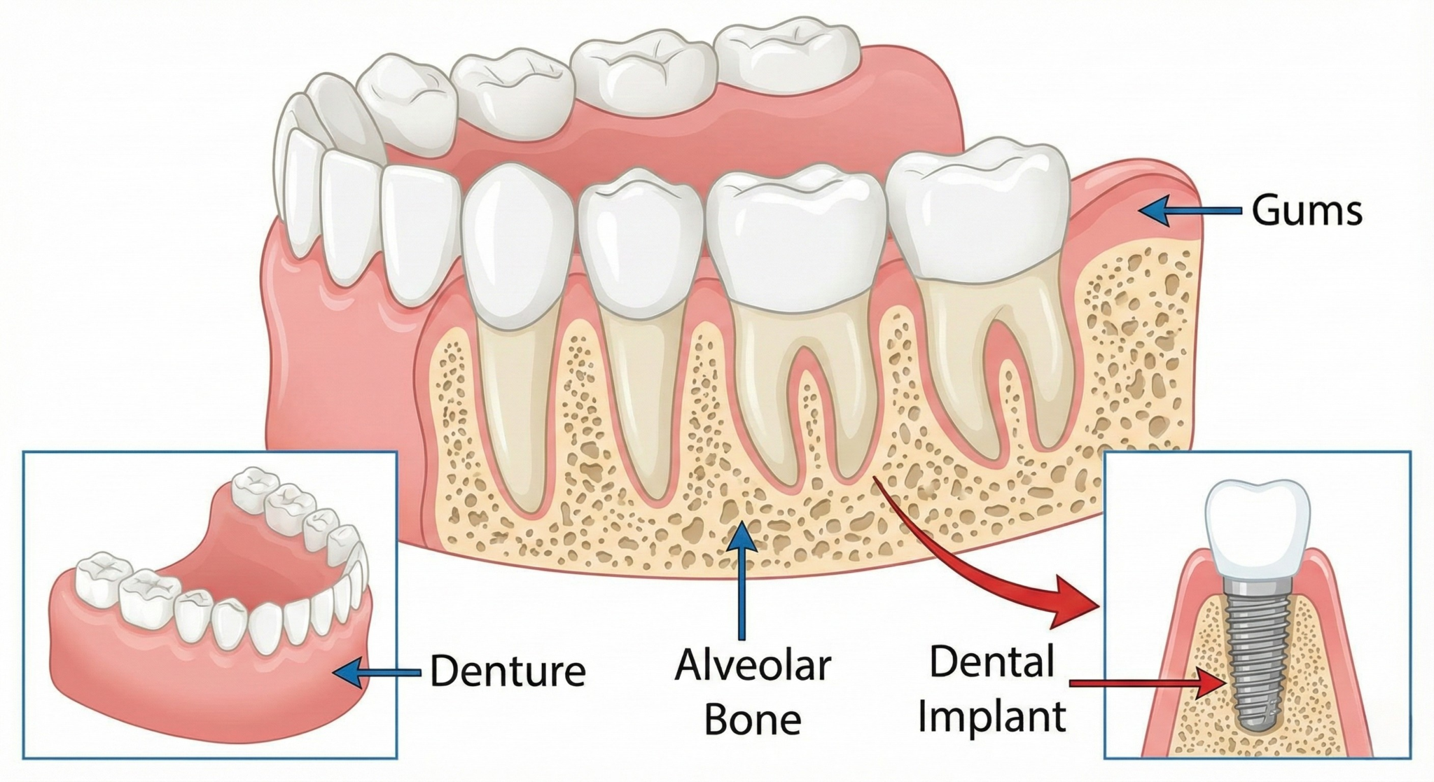 What is a Dental Arch? Implants vs. Dentures | Doctors Implants